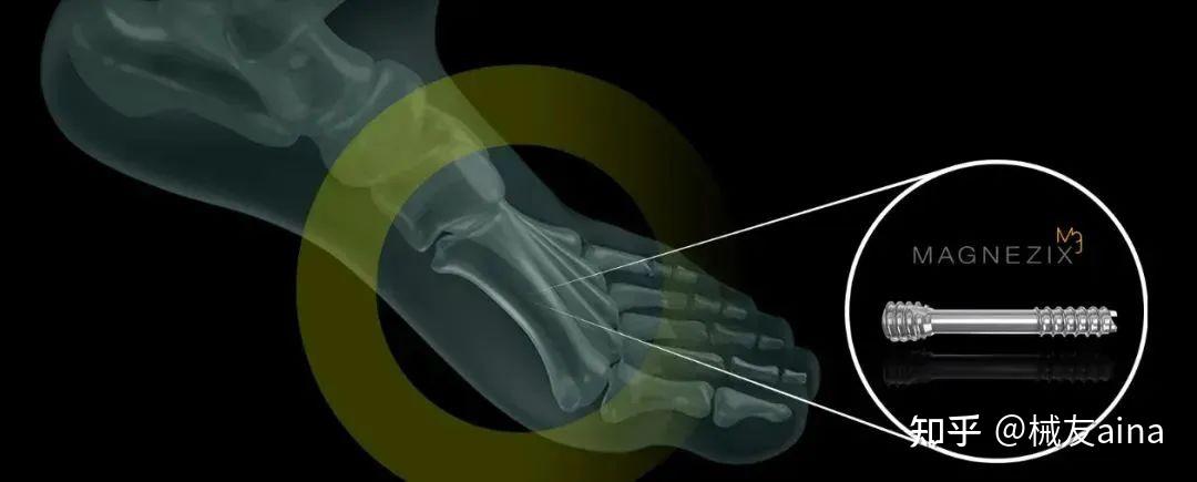 告别二次开刀！全球首款会消失的骨钉登陆中国，骨科百年困局破解；这颗可吸收镁钉颠覆传统，骨科手术1次解决，再也不用二次手术！ - 知乎
