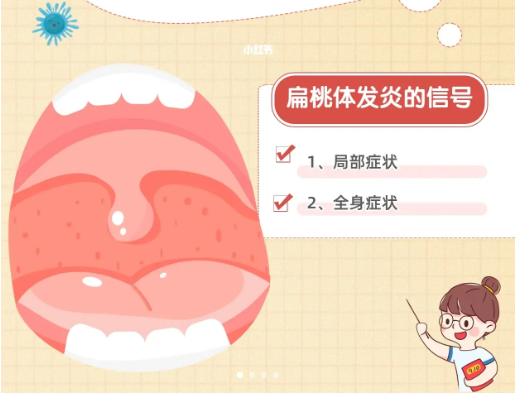 扁桃体总发炎?进来看看这些症状你中了几条 知乎