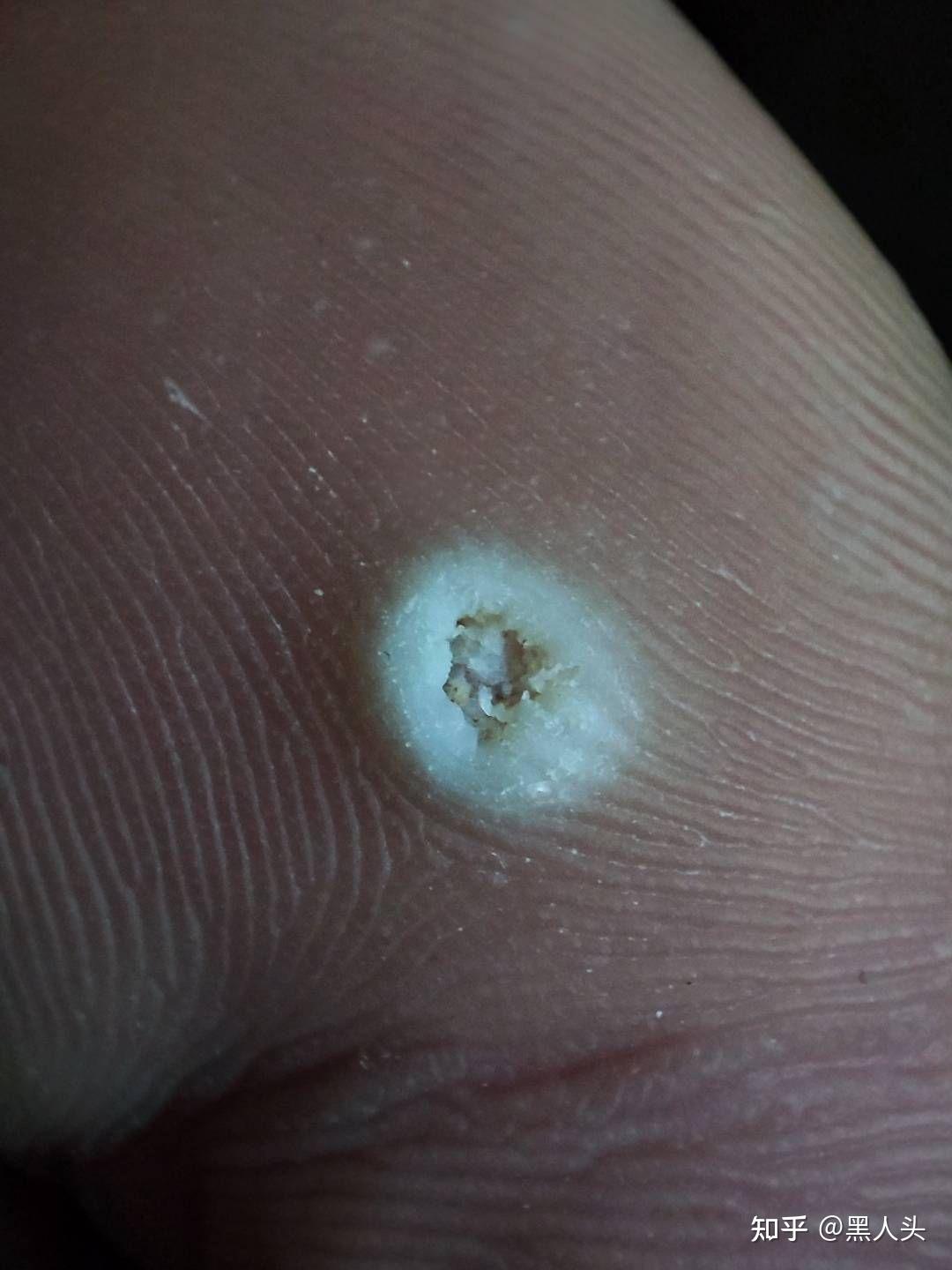 跖疣冷冻治疗全记录 - 知乎