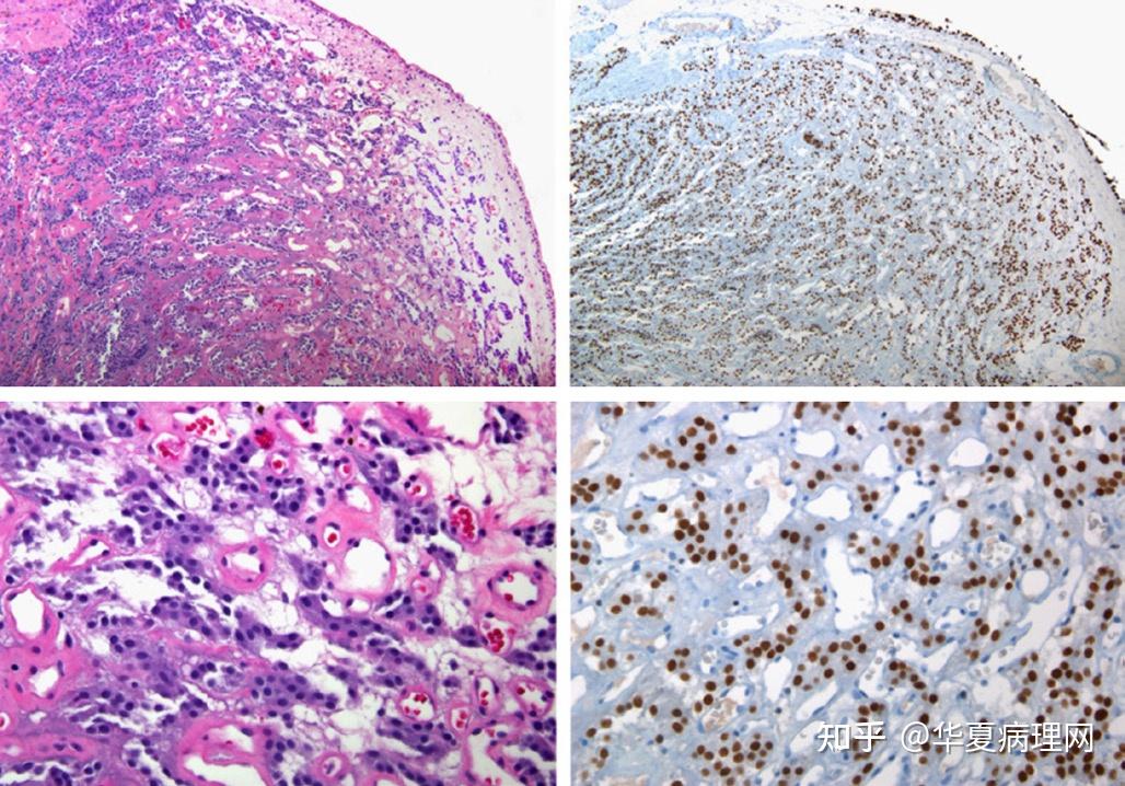 分子时代学病理-GATA3基因 - 知乎