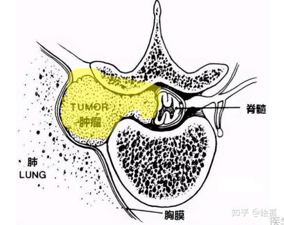 【呼吸系统】纵隔肿瘤 - 知乎