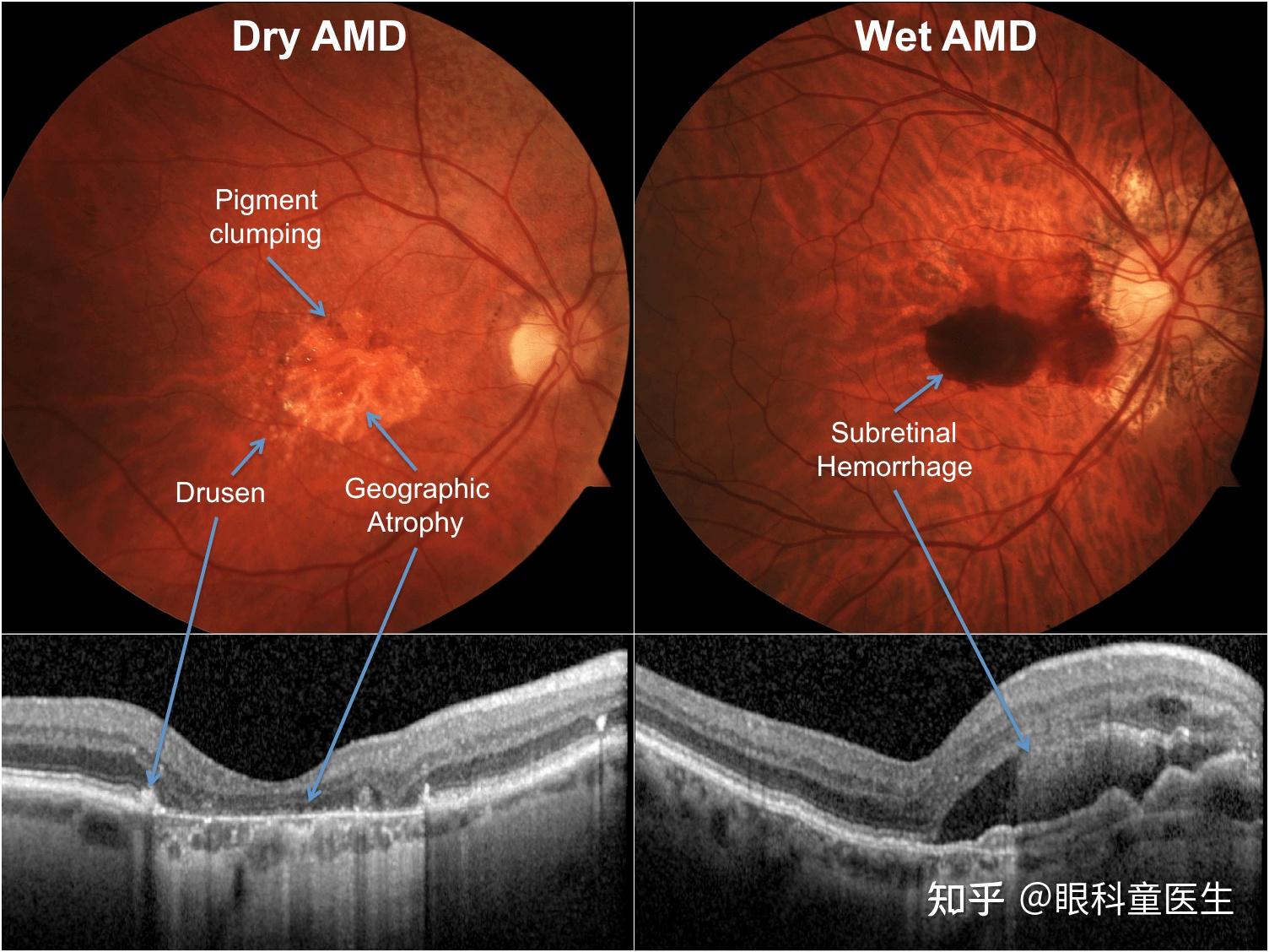视网膜血管性疾病——1、视网膜静脉阻塞 - 知乎