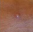Web-scraped Skin Image 皮肤病诊断数据集介绍 - 知乎