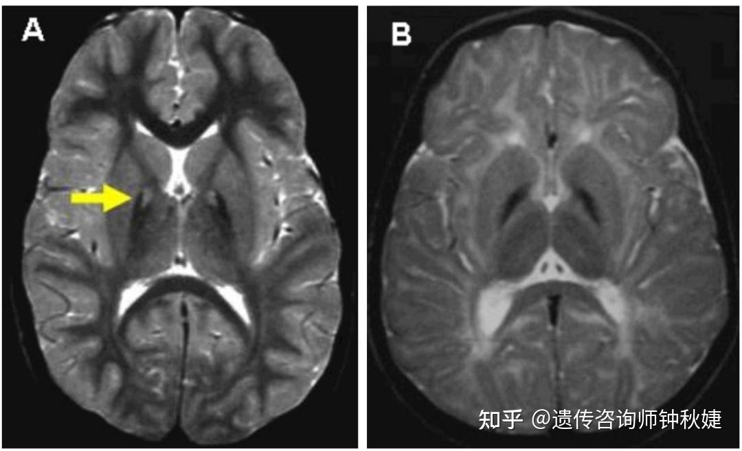神经退行性疾病伴脑铁沉积的基因检测 - 知乎
