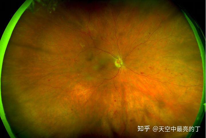 免散瞳、超广角，欧堡带你去看不一样的眼底！ - 知乎