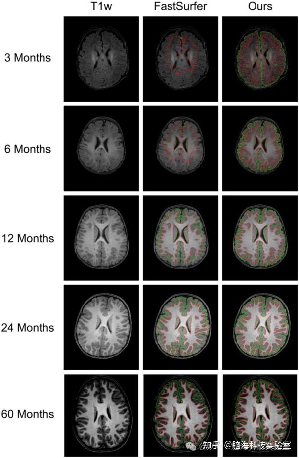 iBEAT V2.0：一个多站点的、基于深度学习的婴儿大脑皮层表面重建Pipeline - 知乎