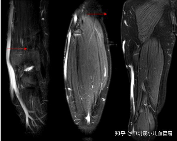 KT综合征(Klippel-Trenaunay syndrome，KTS) 介入治疗 - 知乎