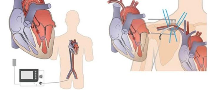 介入式心室辅助装置Impella的结构、特点、并发症及防治 - 知乎