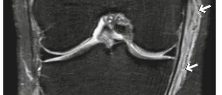 自信诊断-内侧副韧带（MCL）撕裂 - 知乎