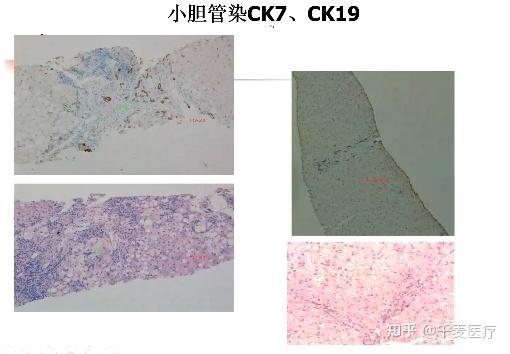肝穿刺活检病理入门 - 知乎