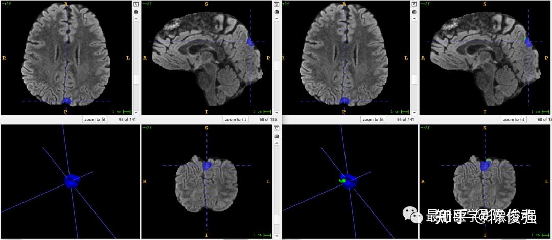 BraTS2023-MEN——BraTS2023颅内脑膜瘤分割挑战赛 - 知乎