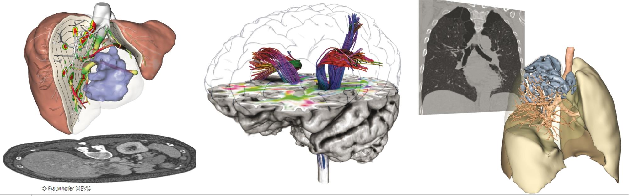 透过MeVisLab，看看德国医疗影像研究所的技术转化之桥