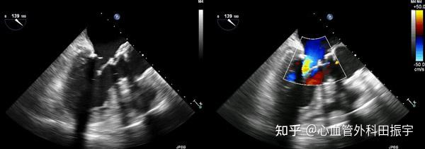半Commando手术：治疗双瓣膜心内膜炎的新技术 - 知乎