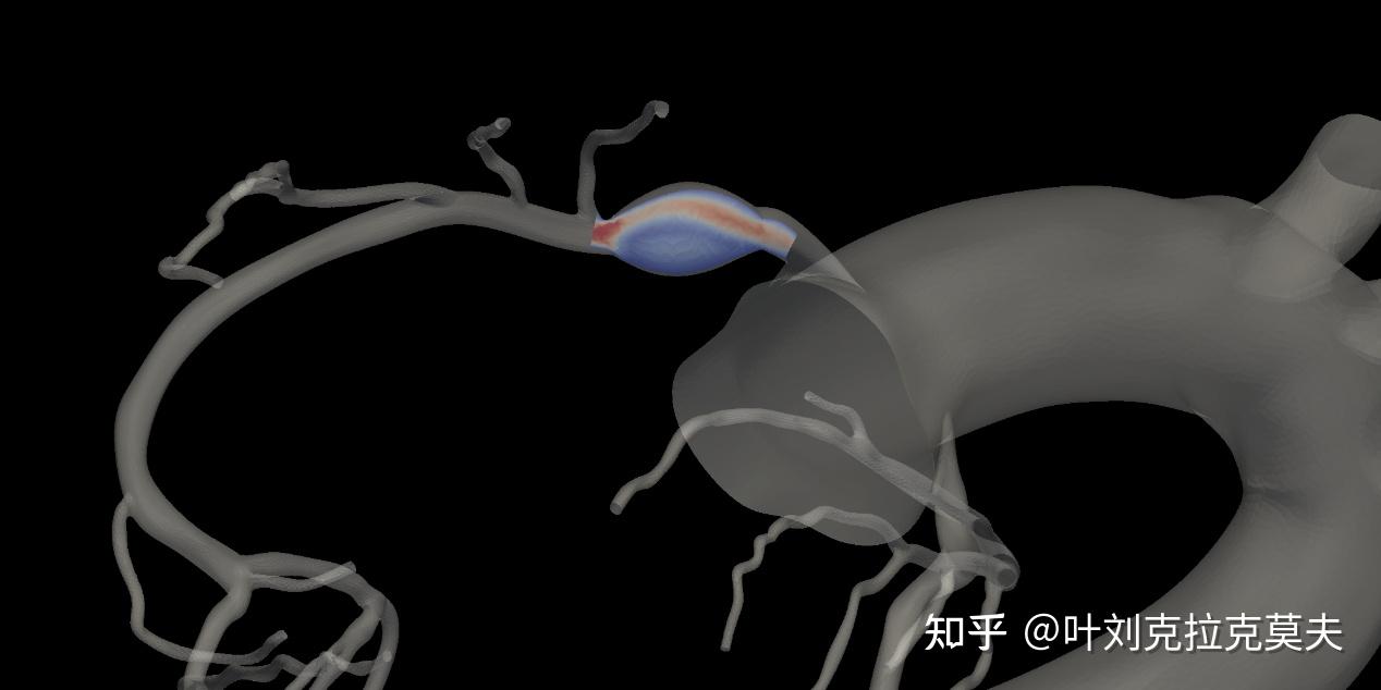 开源科学工程技术软件介绍63 – 血流模拟和分析软件Simvascular - 知乎