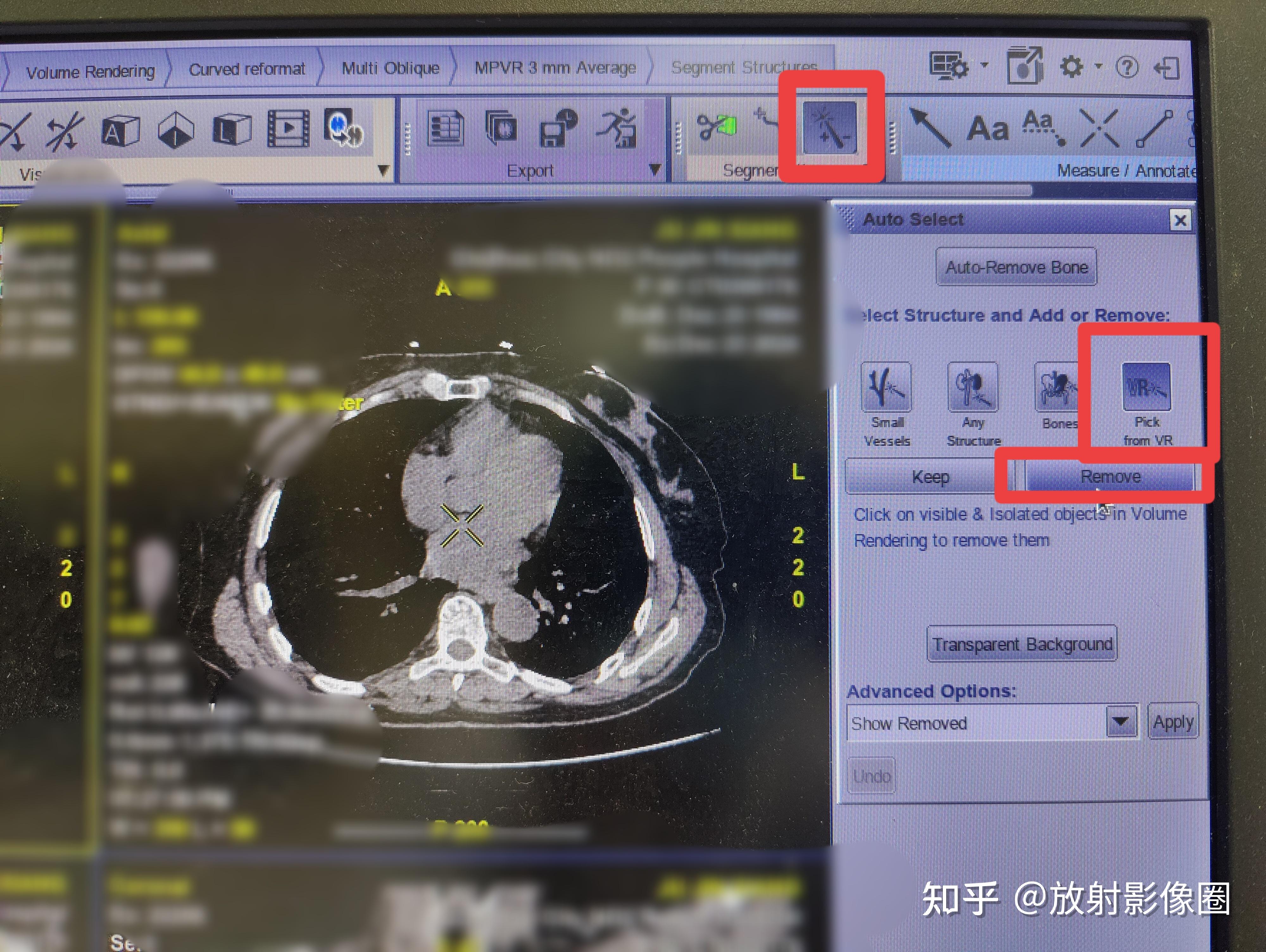 浅谈CT三维重建的操作方法 - 知乎
