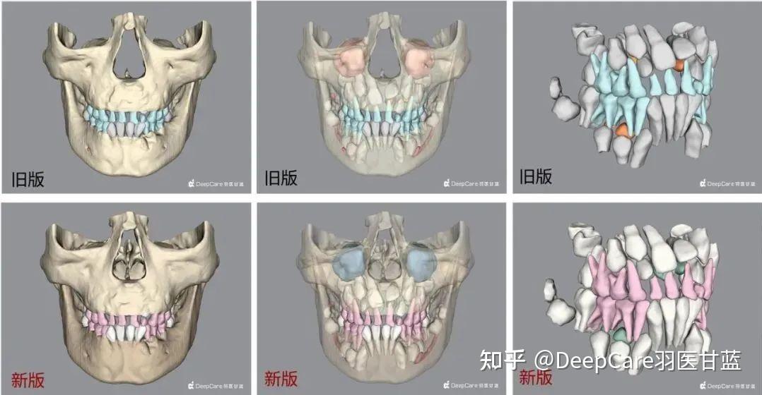 DeepCare羽医甘蓝CBCT最新AI功能登陆IDS 2025，全球开放试用！ - 知乎