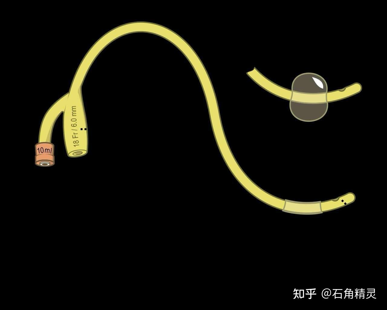 走马观花：Foley尿管 - 知乎