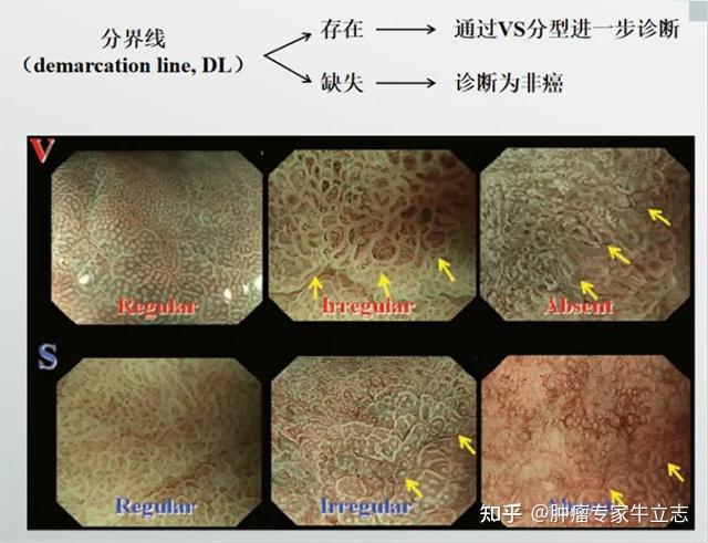 早期胃癌要怎么发现？一文详解早期胃癌的内镜诊断！赶紧收藏！ - 知乎