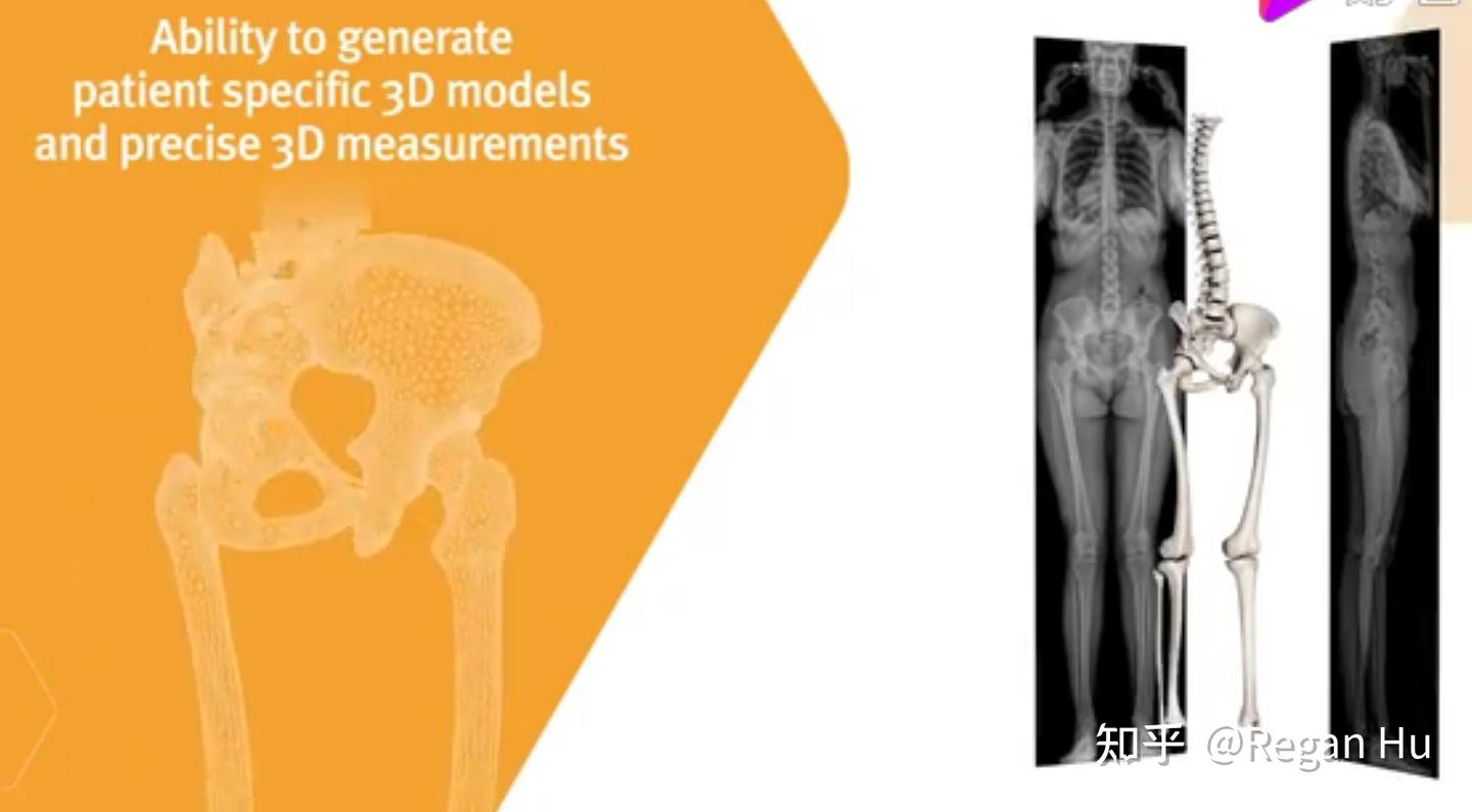 EOS IMAGING EOS全身骨骼三维建模成像系统 - 知乎