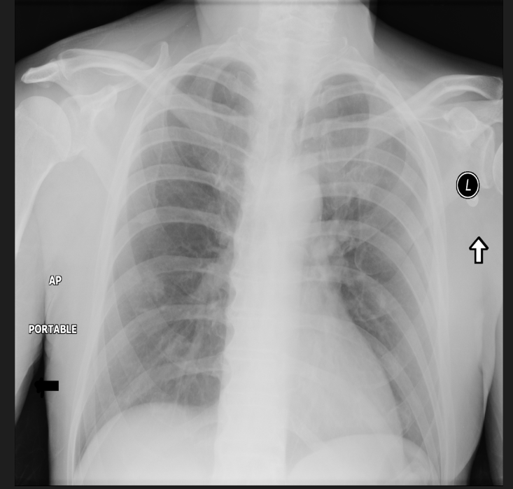 ChestX-Det10 胸畸形实例检测数据集介绍 - 知乎