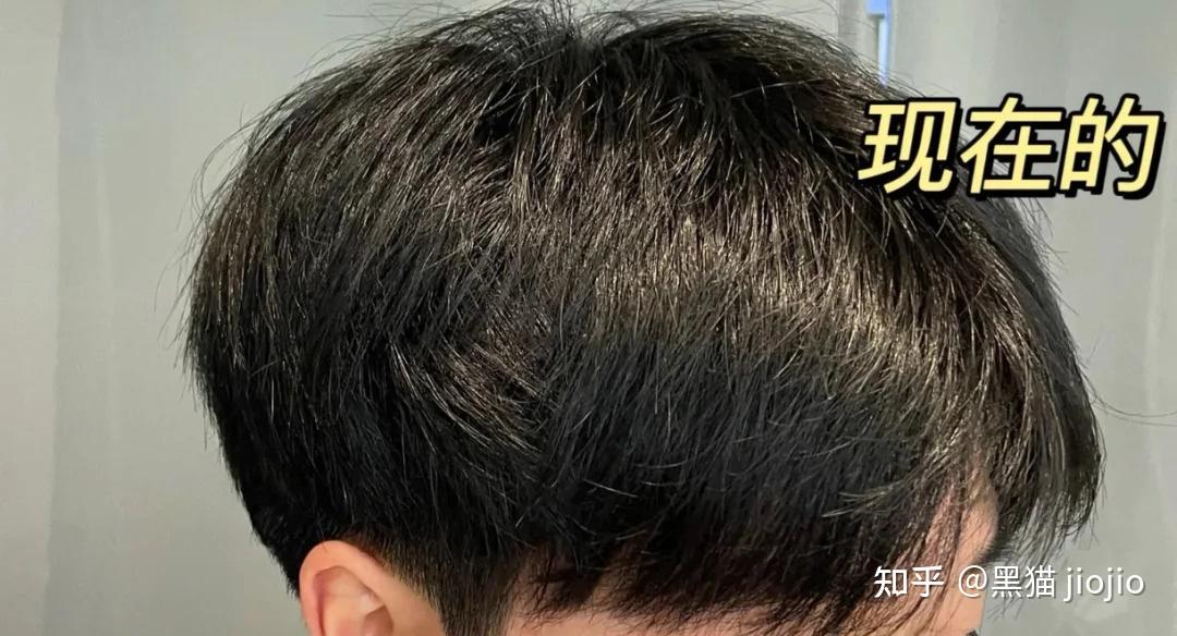 有人用过哈恩咖啡因洗发水吗？控油去屑真那么神奇吗？ - 知乎