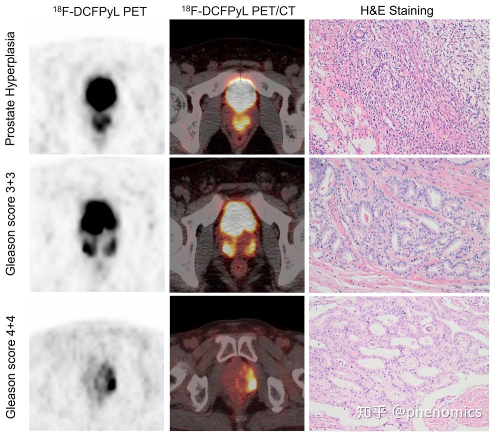 Phenomics | 基于PSMA PET/CT 机器学习模型诊断前列腺癌的病理风险 - 知乎