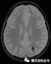 SWI序列原理及临床应用 - 知乎