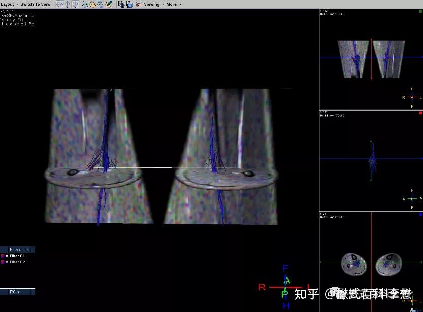 DTI技术原理及临床应用 - 知乎