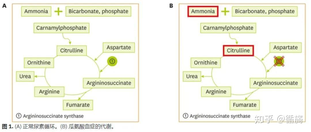 1型瓜氨酸血症CTLN1/精氨酰琥珀酸合成酶缺乏症ASSD：引起高氨血症、血浆谷氨酰胺升高、头痛、新生儿昏迷的尿素循环障碍疾病 - 知乎