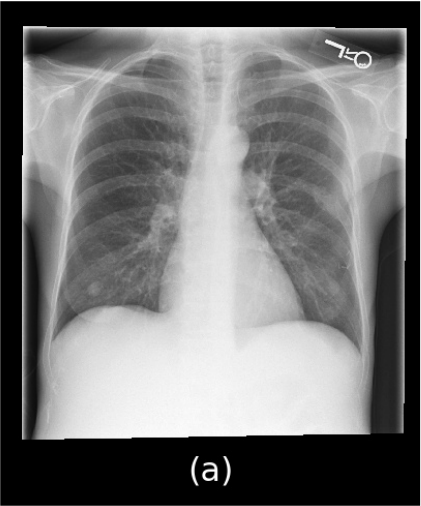 MIMIC-CXR 胸部X光放射学报告数据集介绍 - 知乎