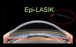 从激光制造商视角看眼科手术革新：飞秒激光的力量 - 知乎