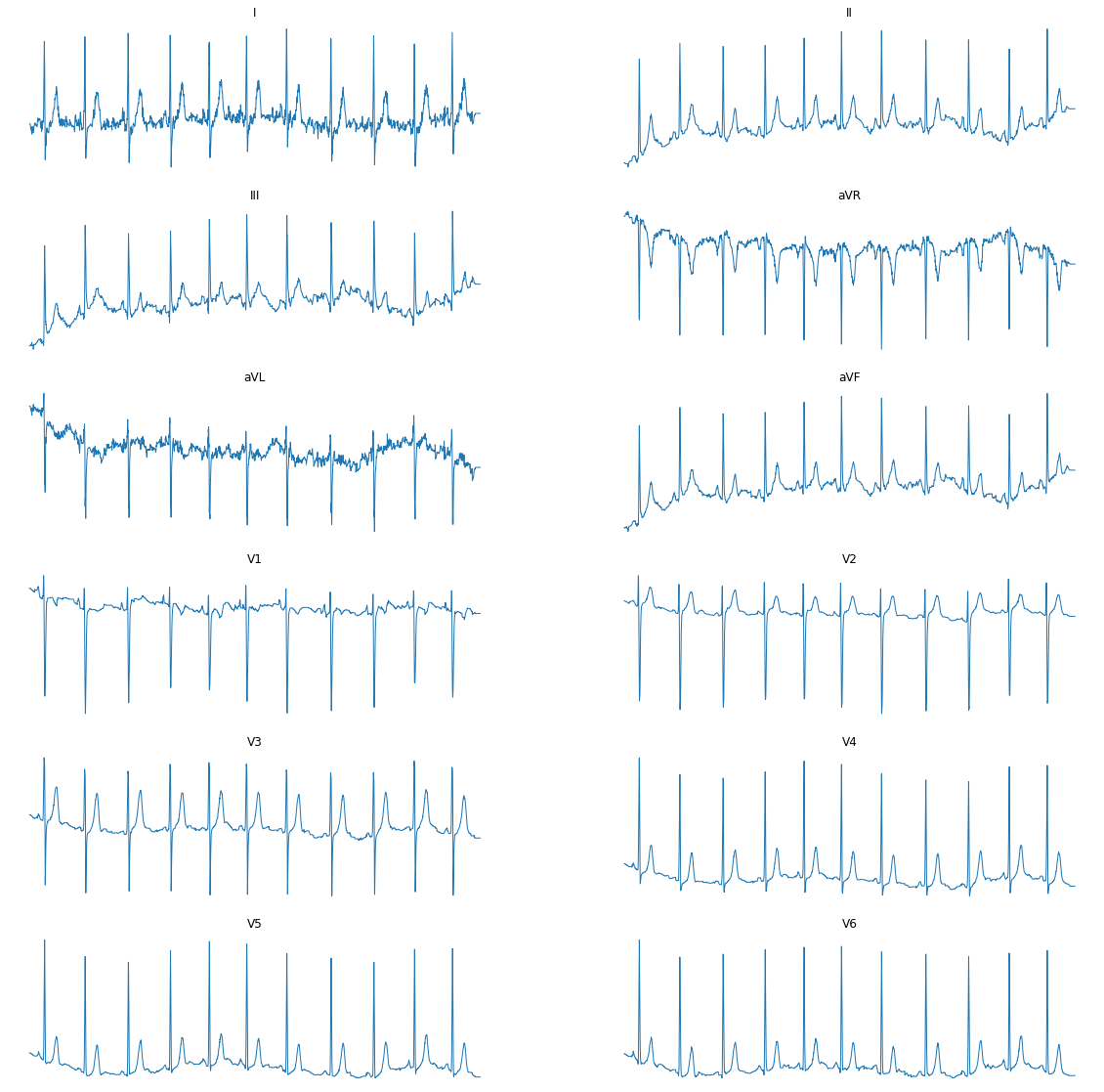 PTB-XL心电随机分类 - 知乎