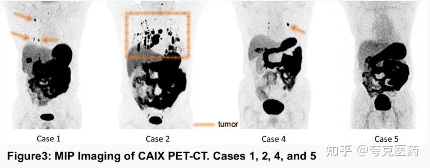 CAIX治疗核药：兵家必争之地！ - 知乎