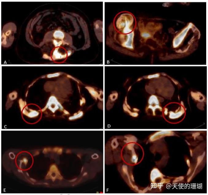 FOP中异位骨骼演化的[18F]NaF PET/CT研究 - 知乎