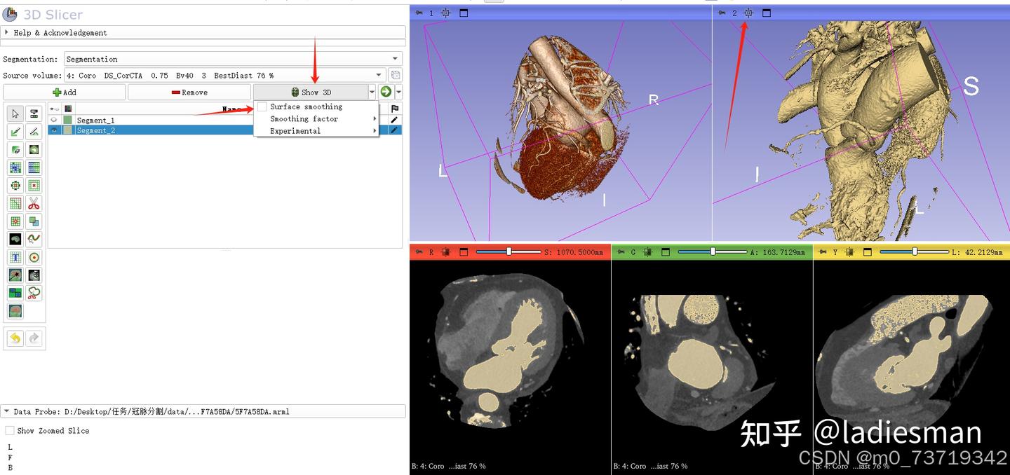 3DSlicer使用指南——冠脉分割 - 知乎