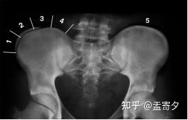 什么是Risser征？ - 知乎