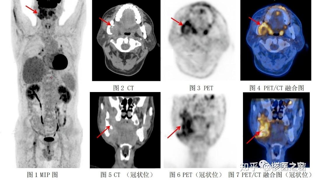 CT/MRI/PET-CT检查有什么区别？ - 知乎
