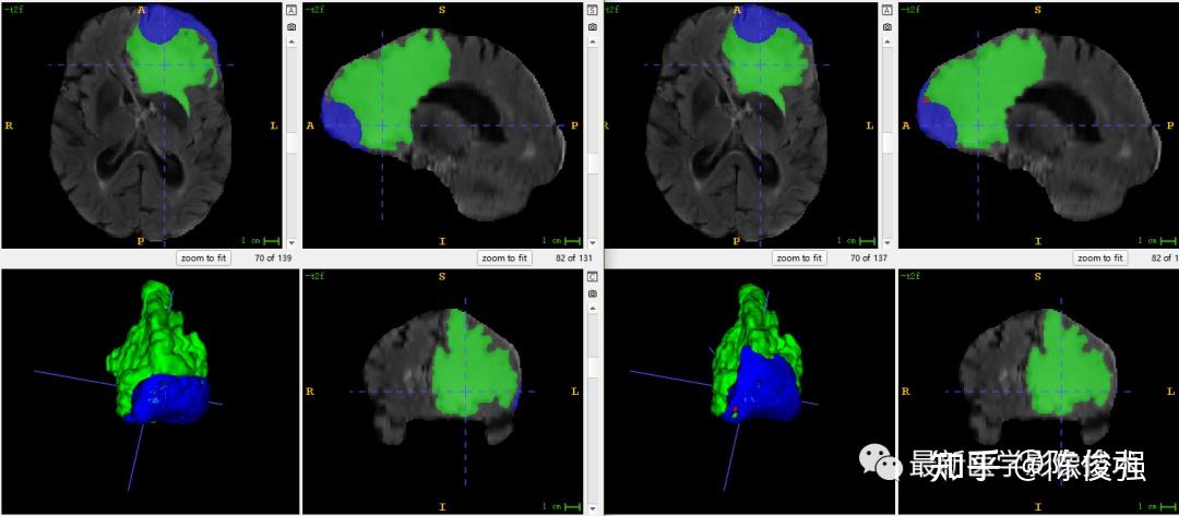 BraTS2023-MEN——BraTS2023颅内脑膜瘤分割挑战赛 - 知乎