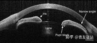 深入解析前房角：您的医生为您检查过吗？ - 知乎