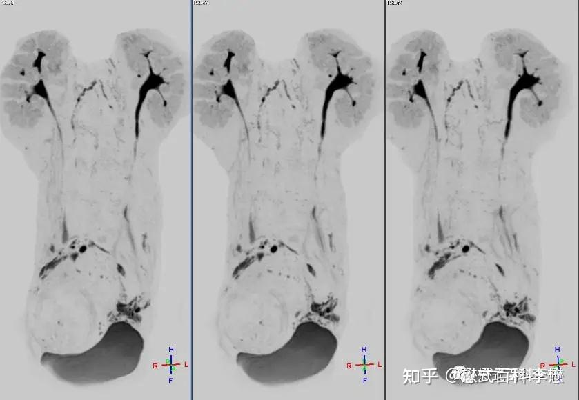 MRU磁共振泌尿系统成像技术及扫描规范
