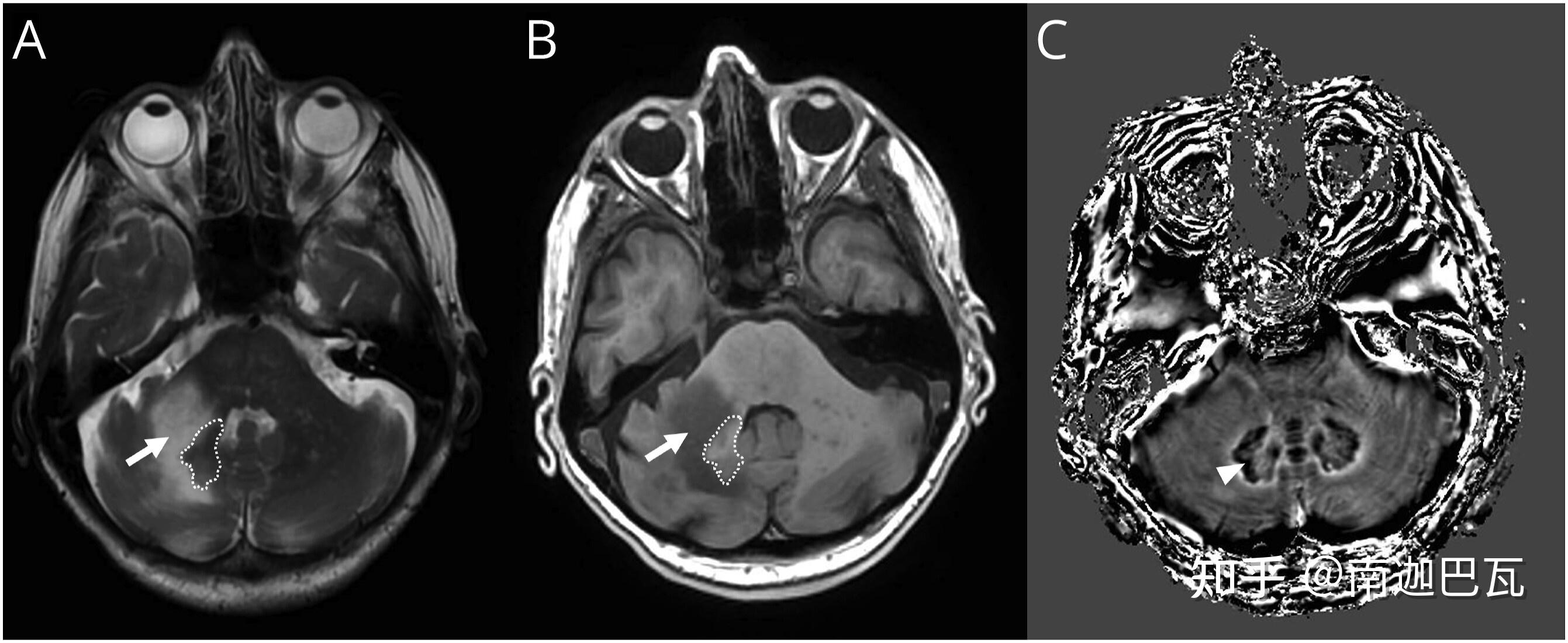 看图识病66|虾征——共济失调性小脑进行性多灶性脑白质病（PML） - 知乎