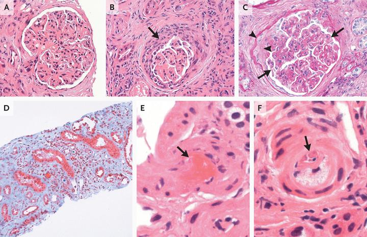 Nejm 2012 Case 32 - 知乎