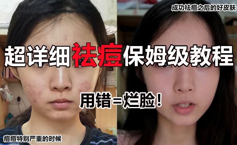 超详细祛痘保姆级教程，这两个祛痘步骤很多新手都会忽略，用错烂脸！痘痘是不是真祛掉了？看完这篇你就知道！ 知乎
