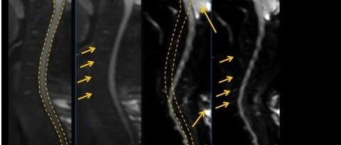 IRIS：多激发SE-EPI扩散（弥散）序列 - 知乎