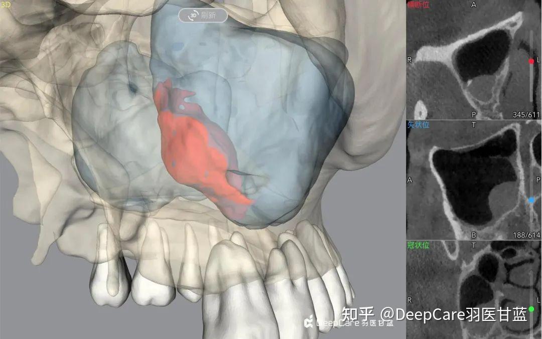 DeepCare羽医甘蓝CBCT最新AI功能登陆IDS 2025，全球开放试用！ - 知乎