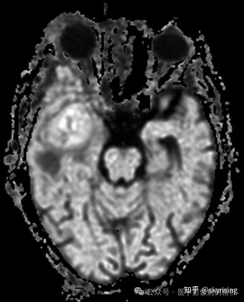 【MRS实战最终版】五例脑实质肿瘤或肿瘤性病变或良性病变MRS影像鉴别诊断并中英文报告模板范例 - 知乎