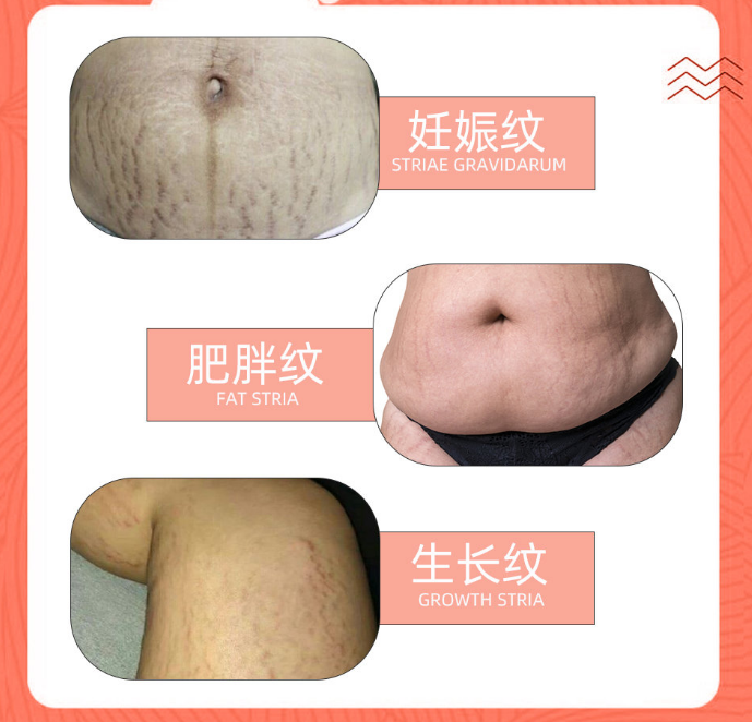 妊娠纹、生长纹这些纹路到到底怎么区分呢? 知乎