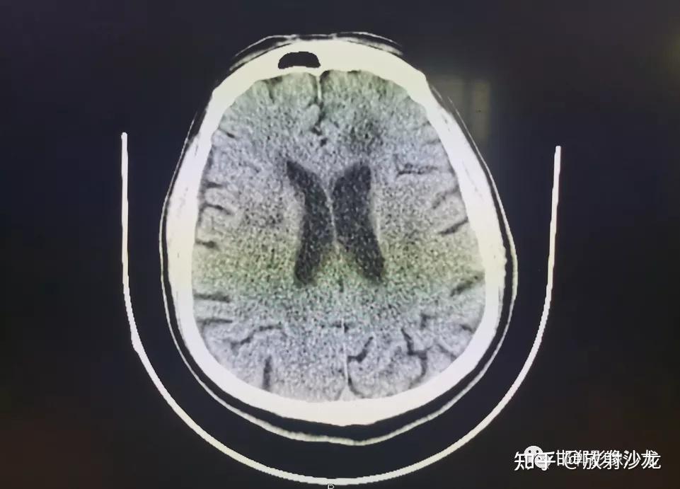 CTP在急性缺血性脑血管病应用病例分享 - 知乎