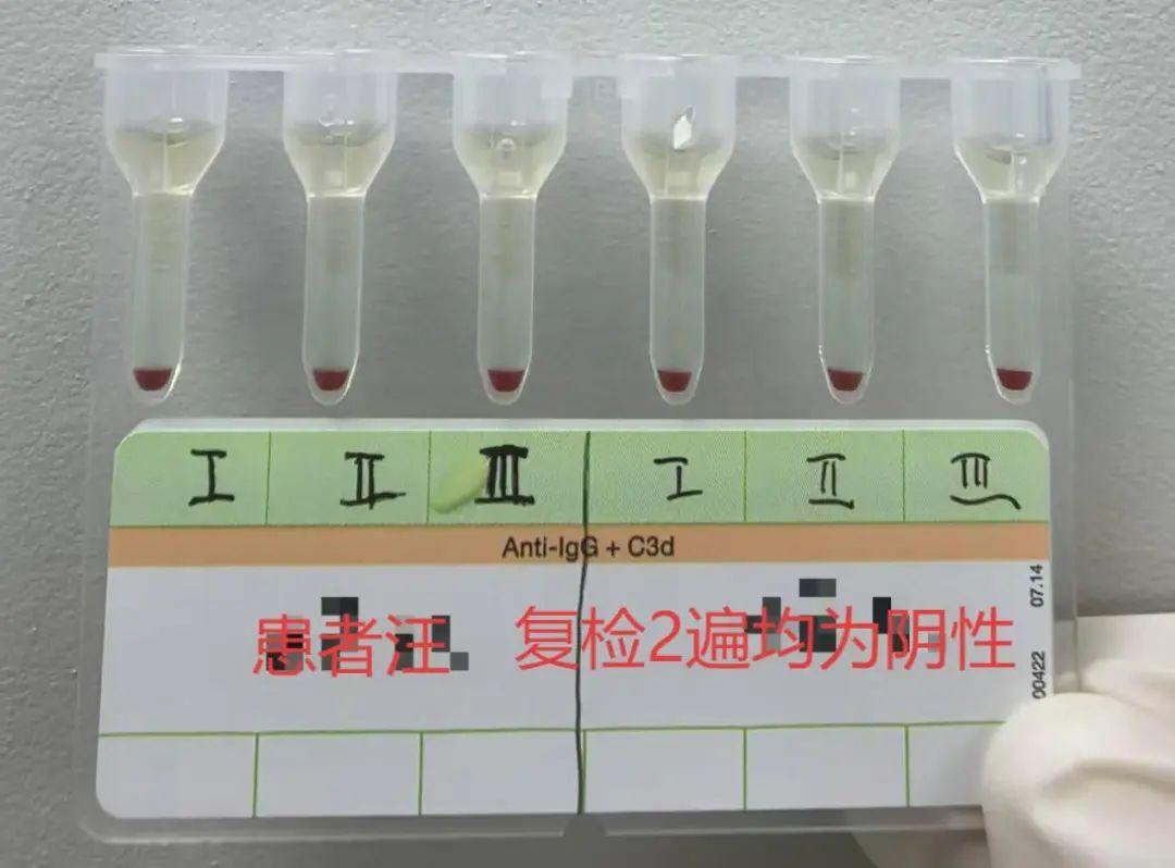 一例不规则抗体筛查检出抗-Mur抗体的案例分享 - 知乎