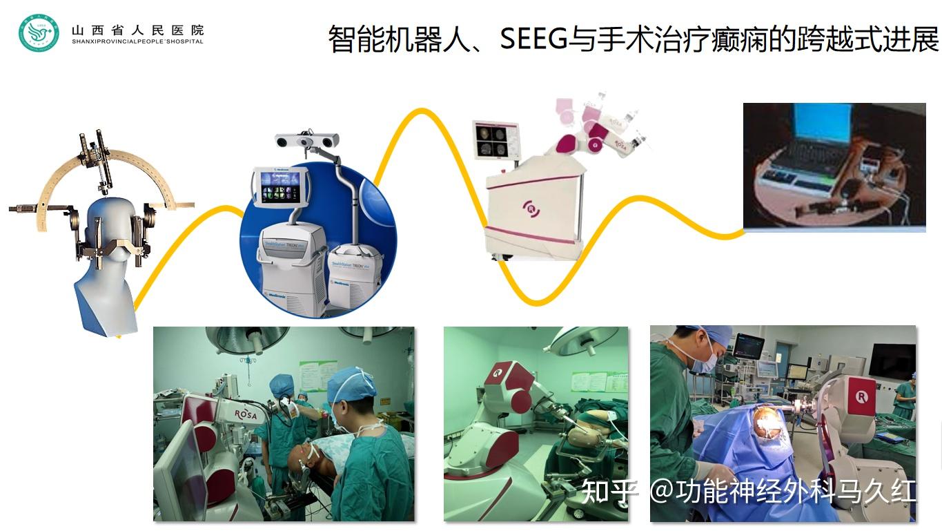 【癫痫科普】ROSA机器人辅助SEEG电极置入术,靶点定位精准、效果更好 - 知乎